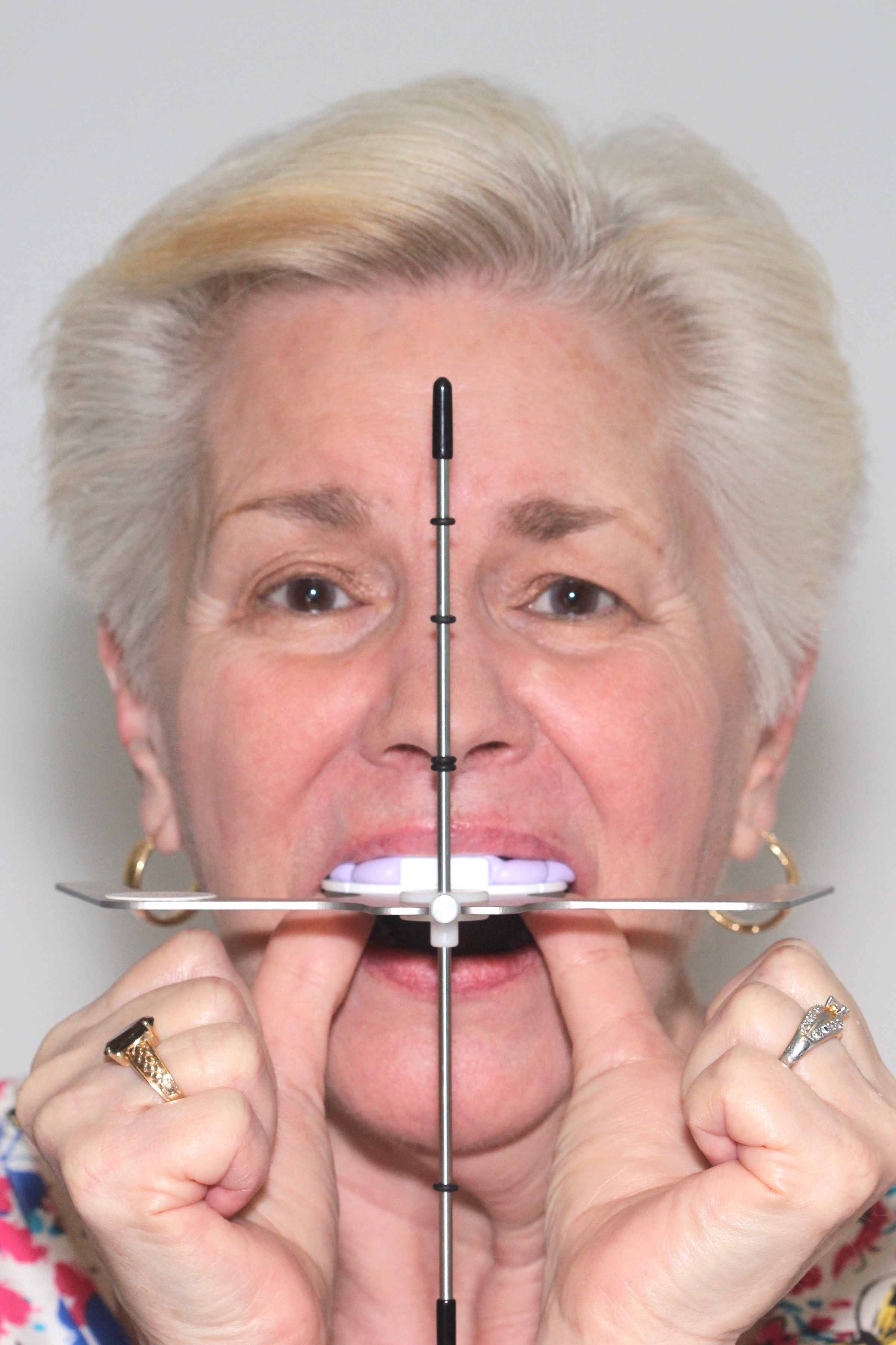 Digital face-bow transfer technique dentofacial analyser for dental ...